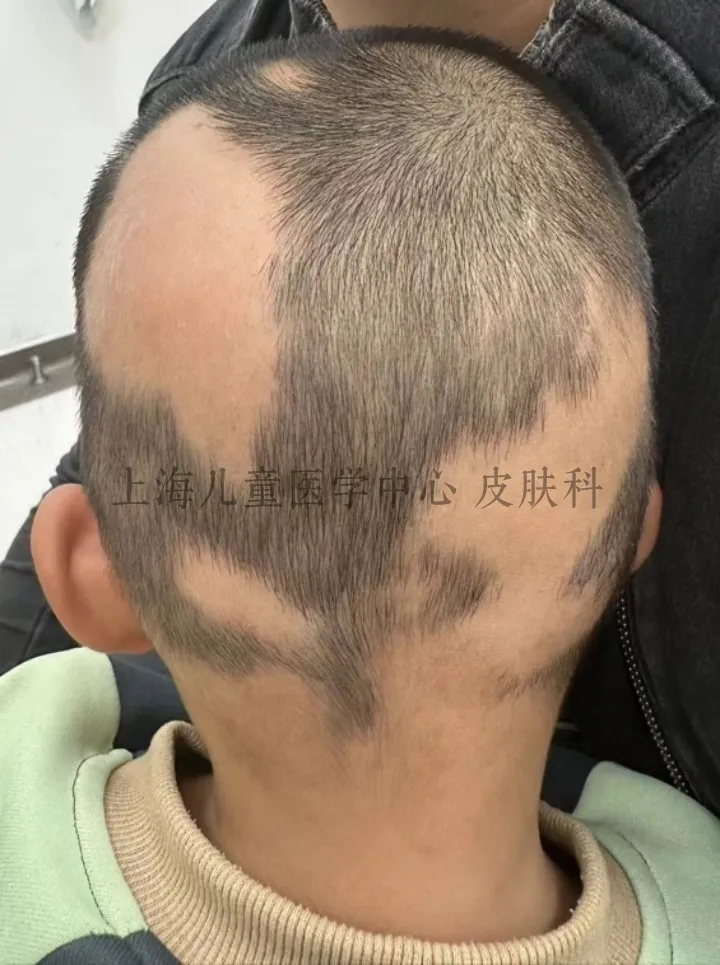 儿童重症斑秃——当头发“集体出逃”我们该如何科学应对_澎湃号·湃客_澎湃新闻-The Paper